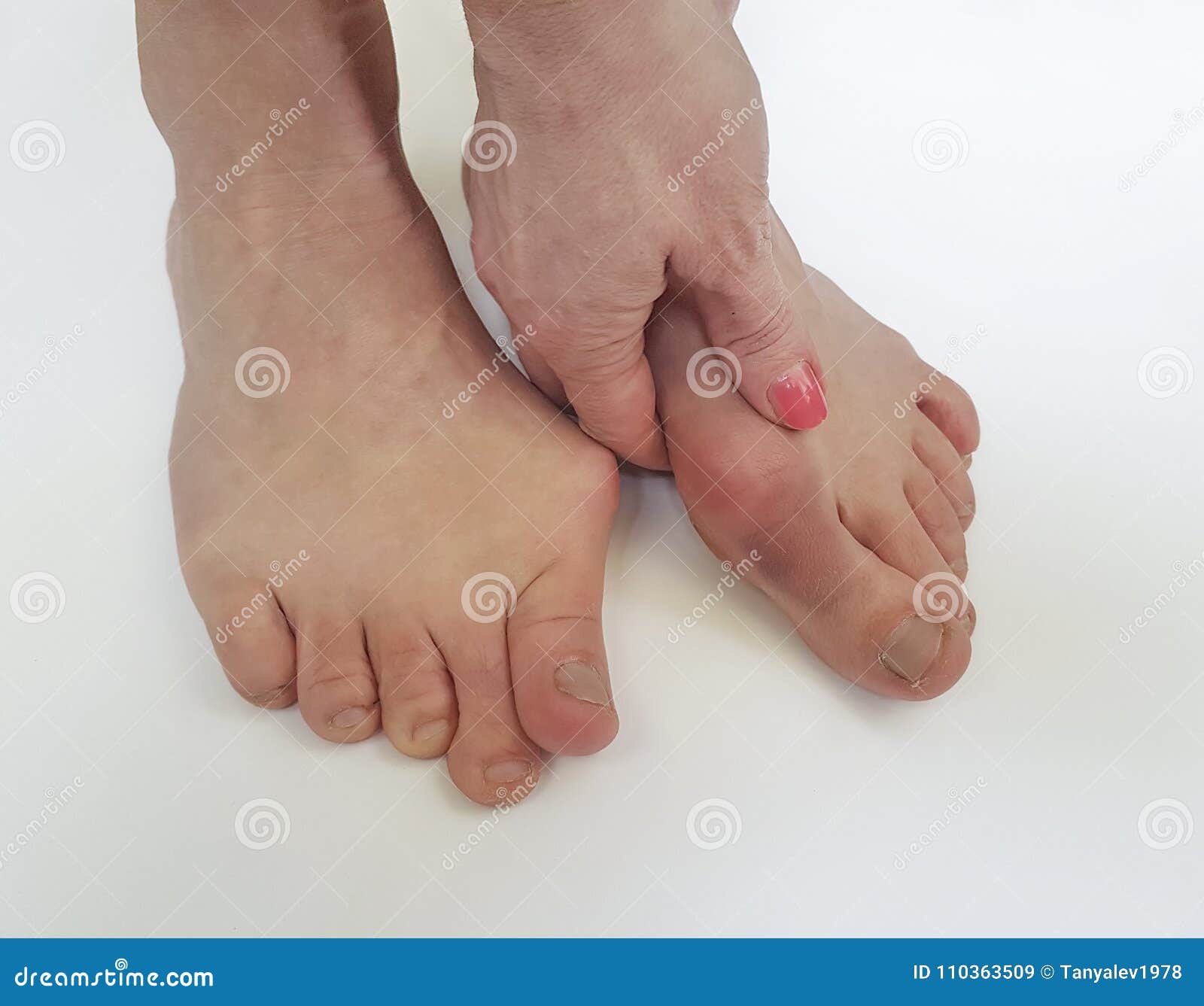 Valgus Deformity Of Legs Royalty-Free Stock Image | CartoonDealer.com ...