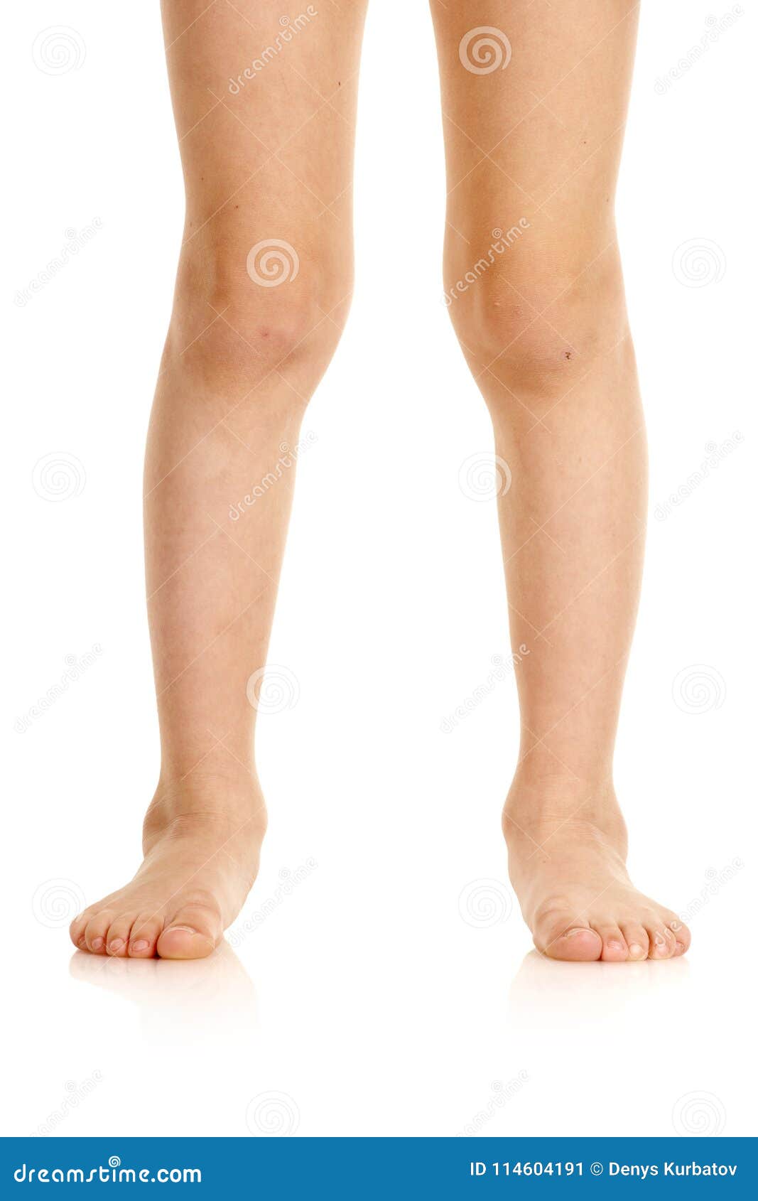 Valgus deformity of legs stock image. Image of closeup - 114604191