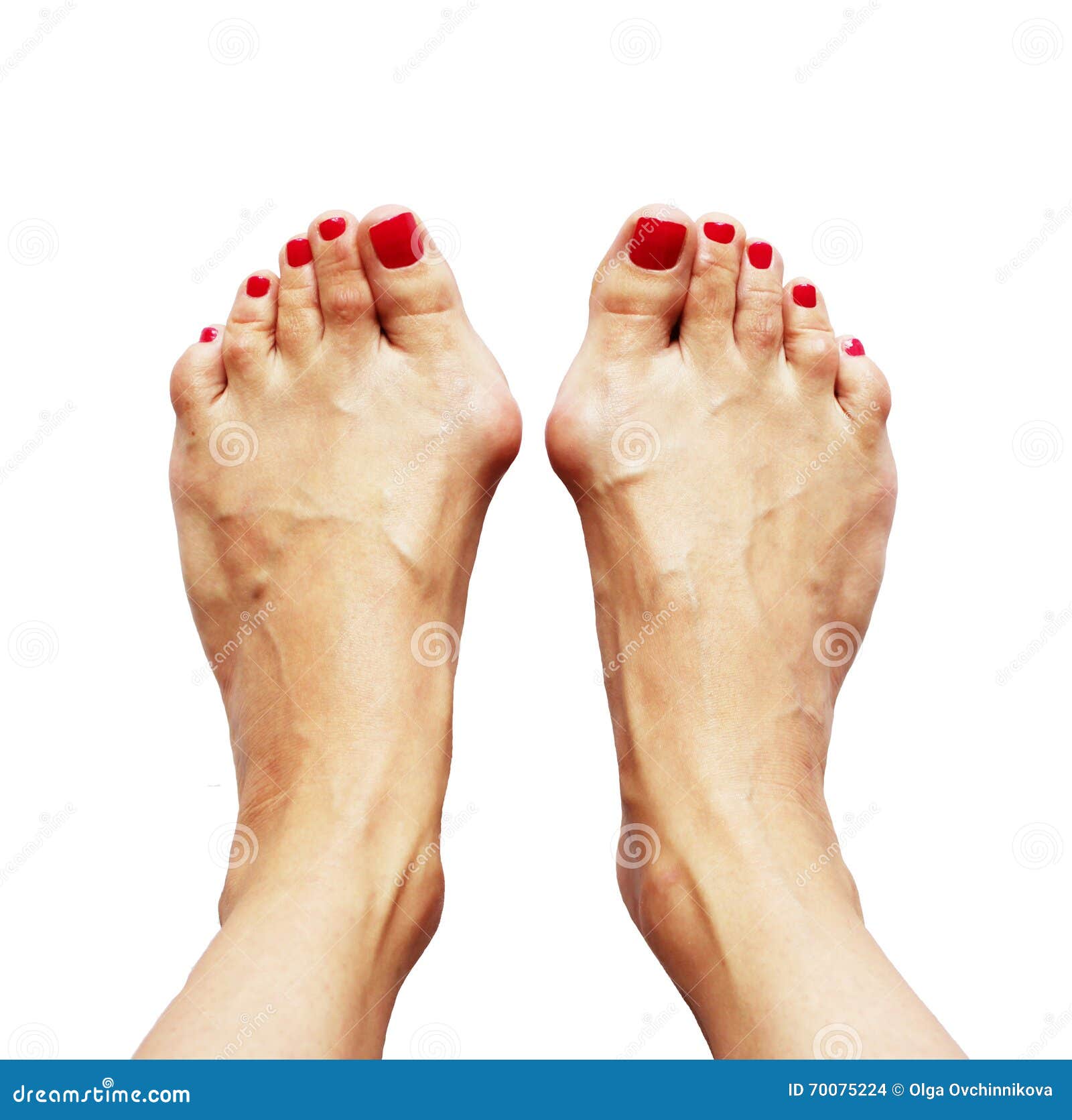 Valgus Deformity of Legs Due of the Cross Flatfoot (hallux Valgus ...