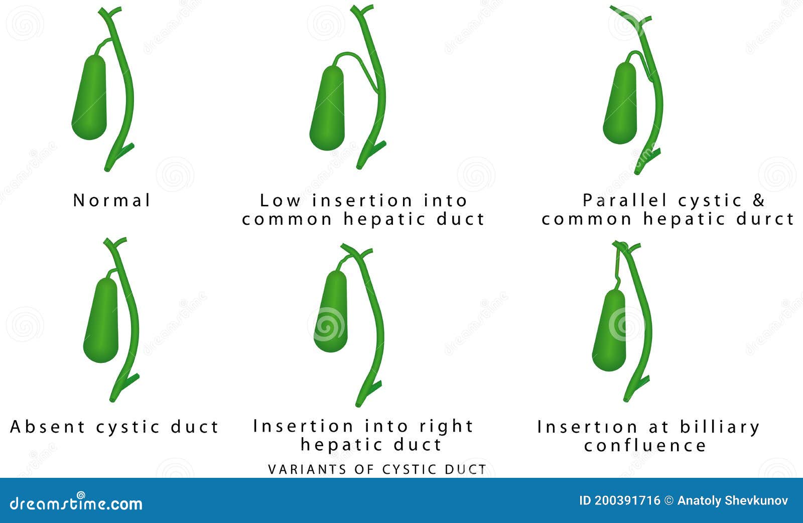 Variants of cystic duct stock vector. Illustration of care - 200391716