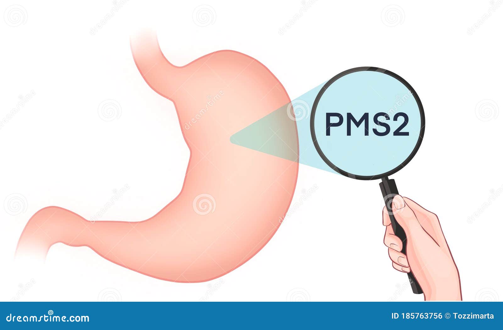 Variants of the PMS2 Gene are Associated with an Increased Risk of ...