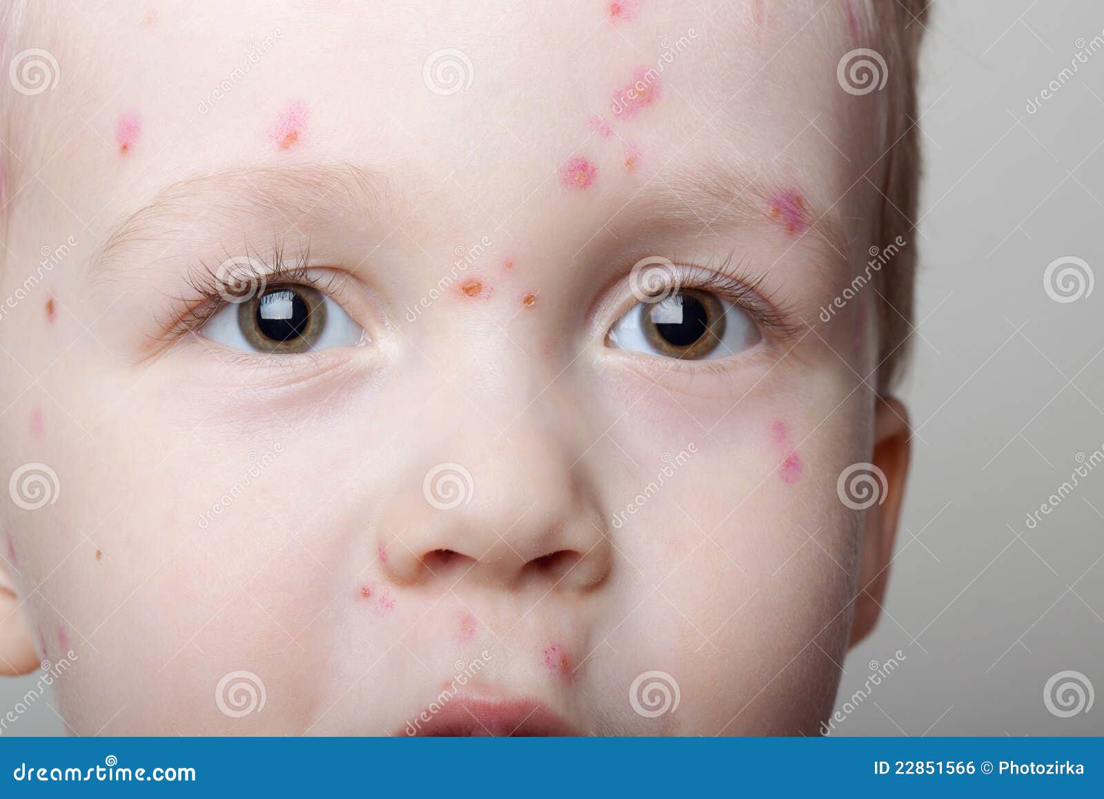 Varicella fotografia stock. Immagine di bambino, malato - 22851566