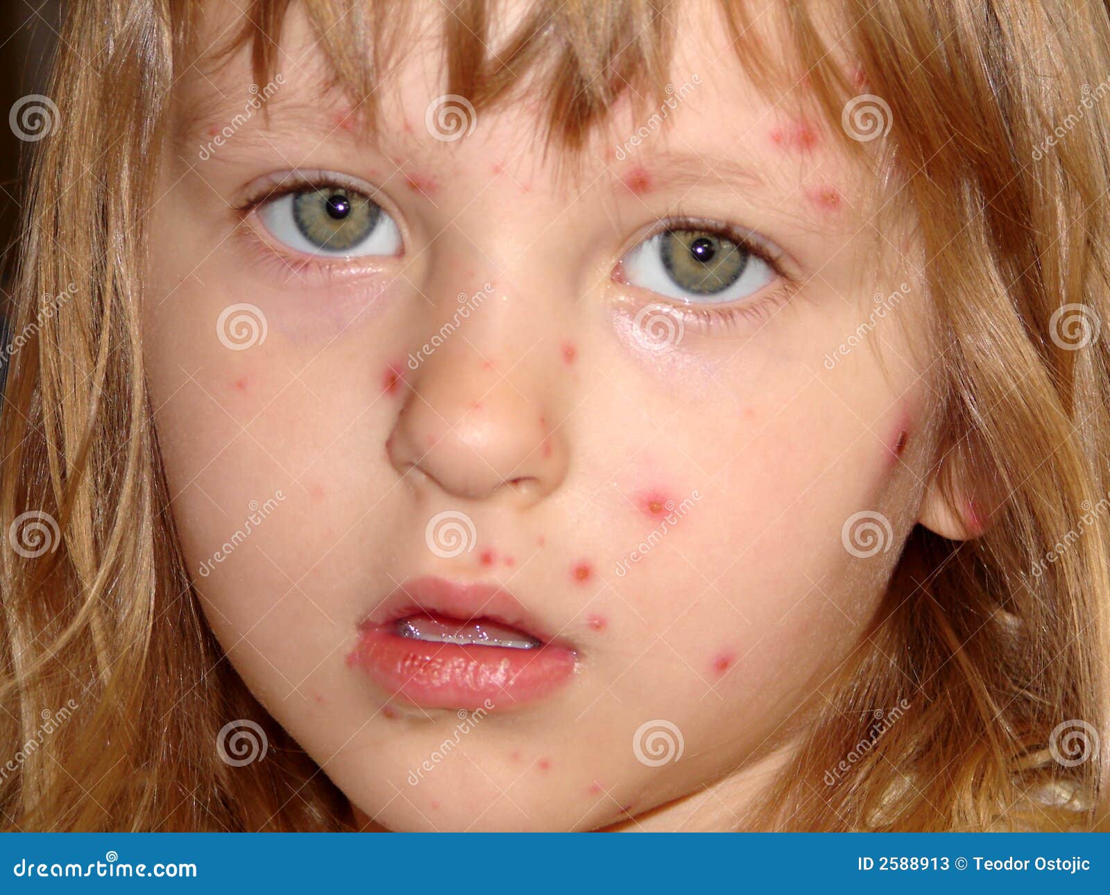Varicelle image stock. Image du malade, brouillon, varicelle - 2588913