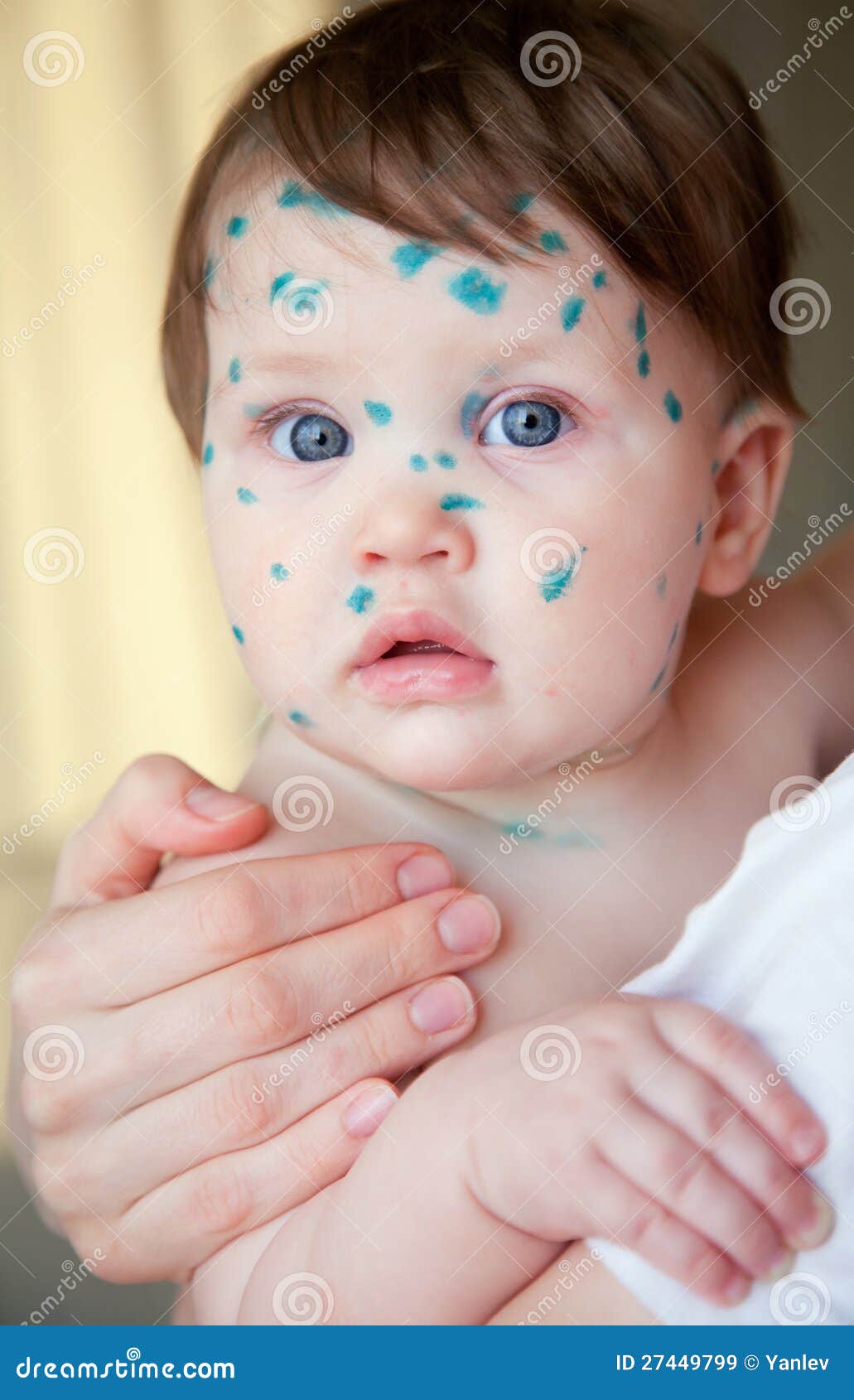 Varicelle chez les enfants image stock. Image du teinture - 27449799