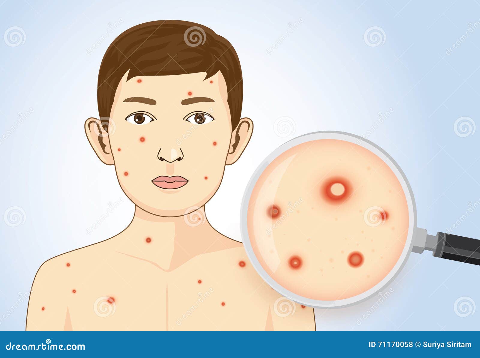 Varicelle De Agrandissement Des Enfants Illustration de Vecteur ...