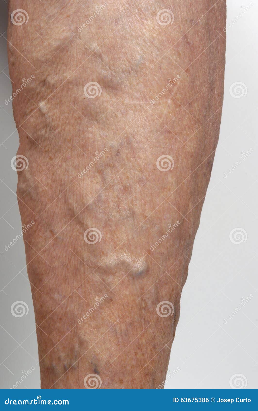 Varices En La Pierna De Una Mujer, Foto de archivo - Imagen de estudio ...