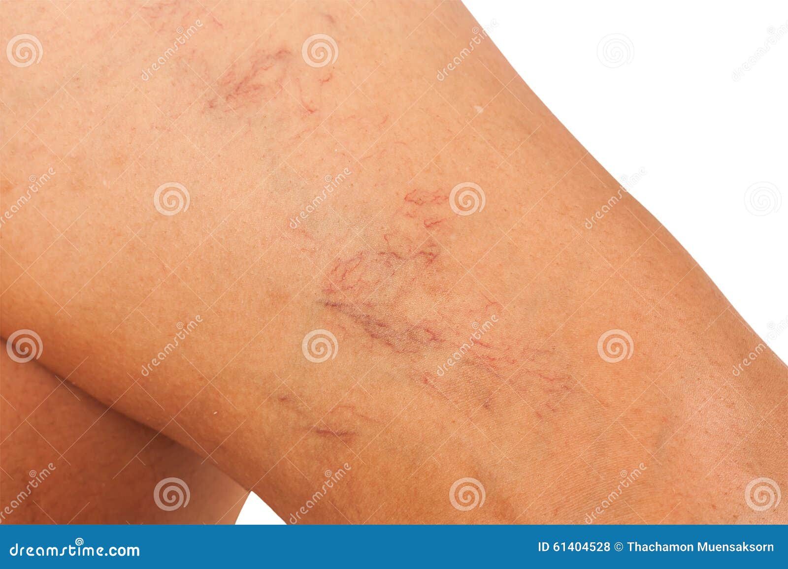 Varices en las piernas foto de archivo. Imagen de riesgo - 61404528