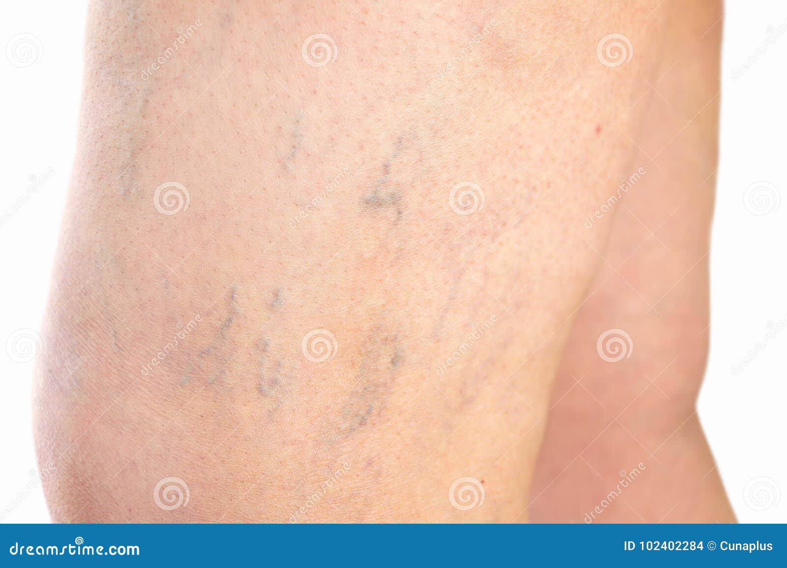 Varices en una pierna foto de archivo. Imagen de skincare - 102402284
