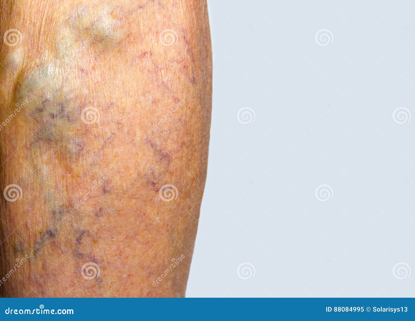 Varices en una pierna imagen de archivo. Imagen de varicoso - 88084995