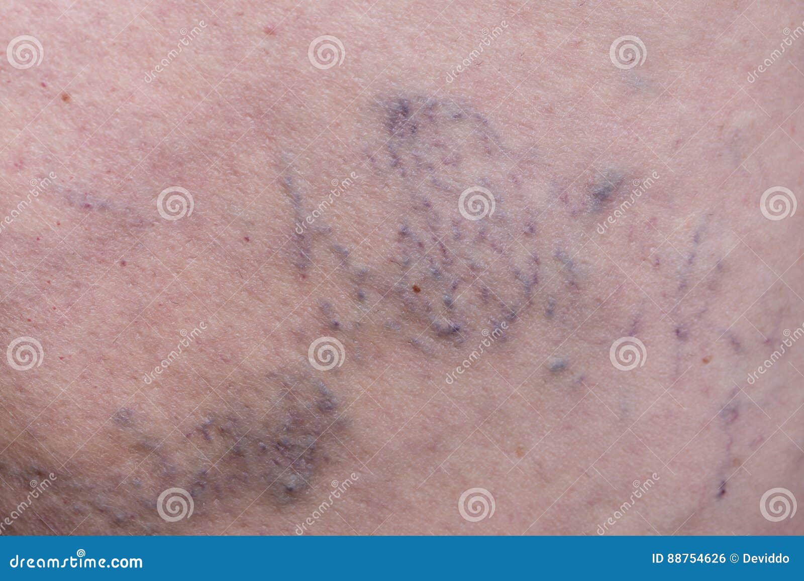 The varicose on legs stock photo. Image of system, varicose - 88754626