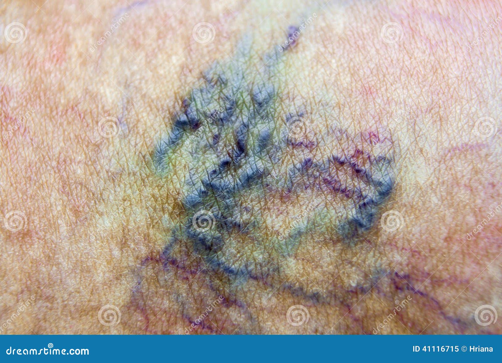 Varicose vain stock image. Image of close, dermatitis - 41116715
