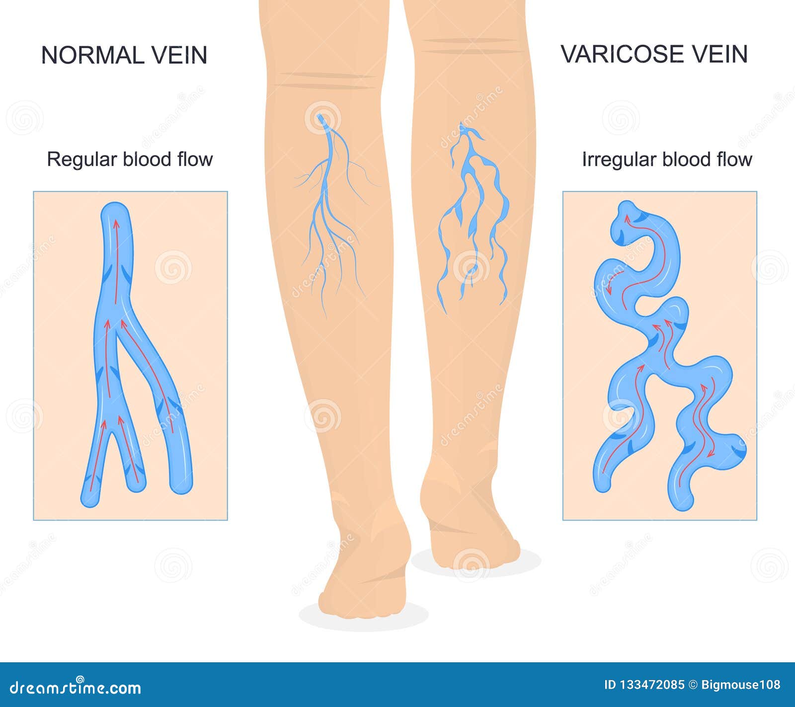 Varicose Veins Concept Banner Card with Elements. Vector Stock Vector ...