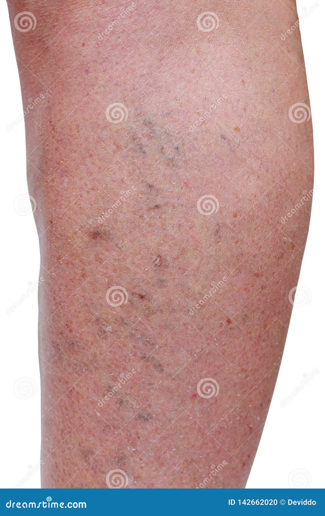 The varicose veins stock photo. Image of thrombosis - 142662020