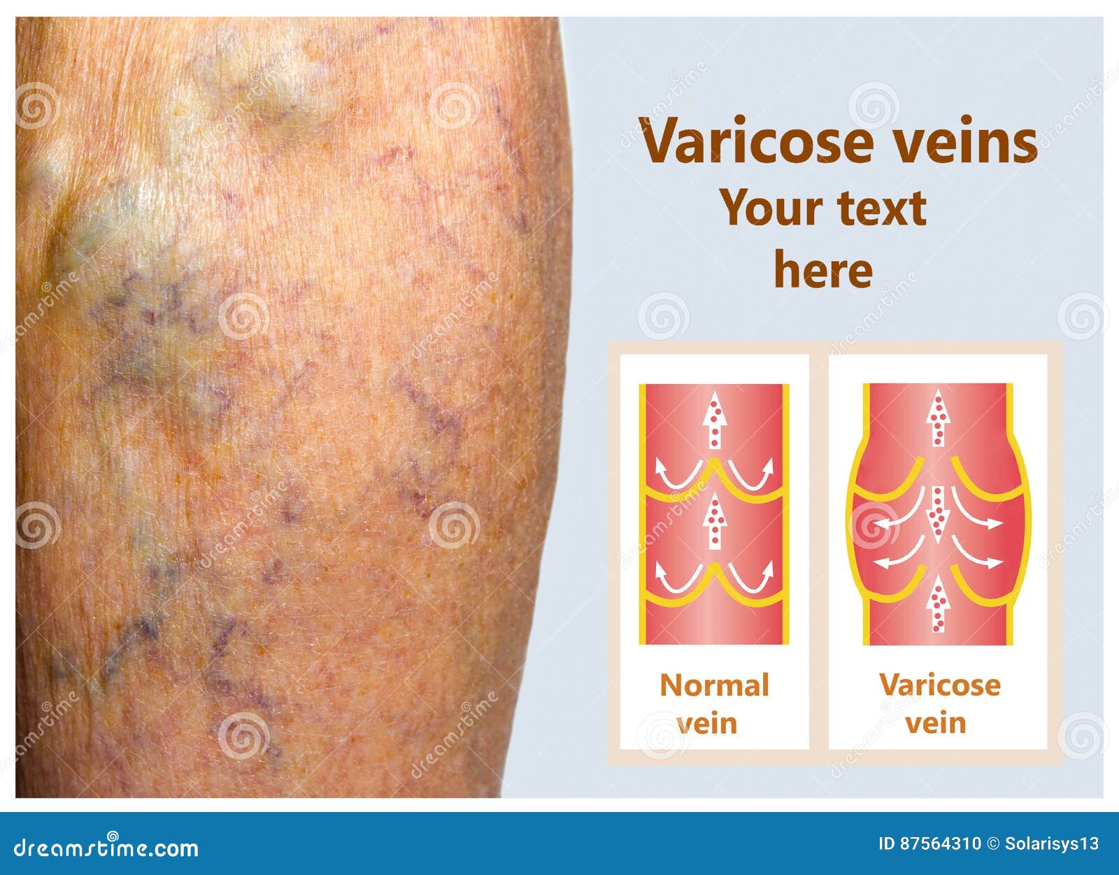 Varicose Veins On A Female Senior Leg Royalty-Free Stock Image ...