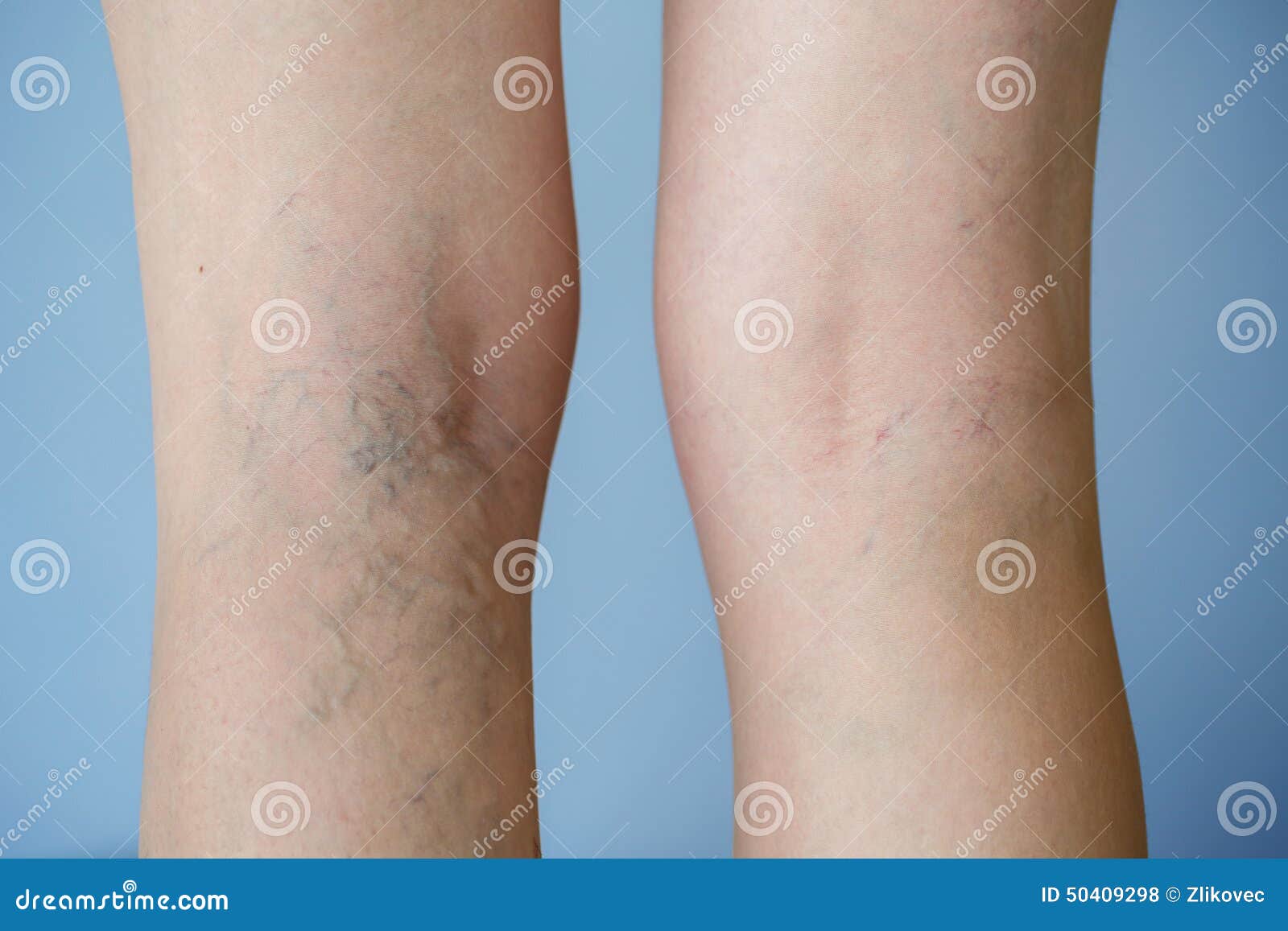 Varicose veins stock photo. Image of eczema, healthcare - 50409298