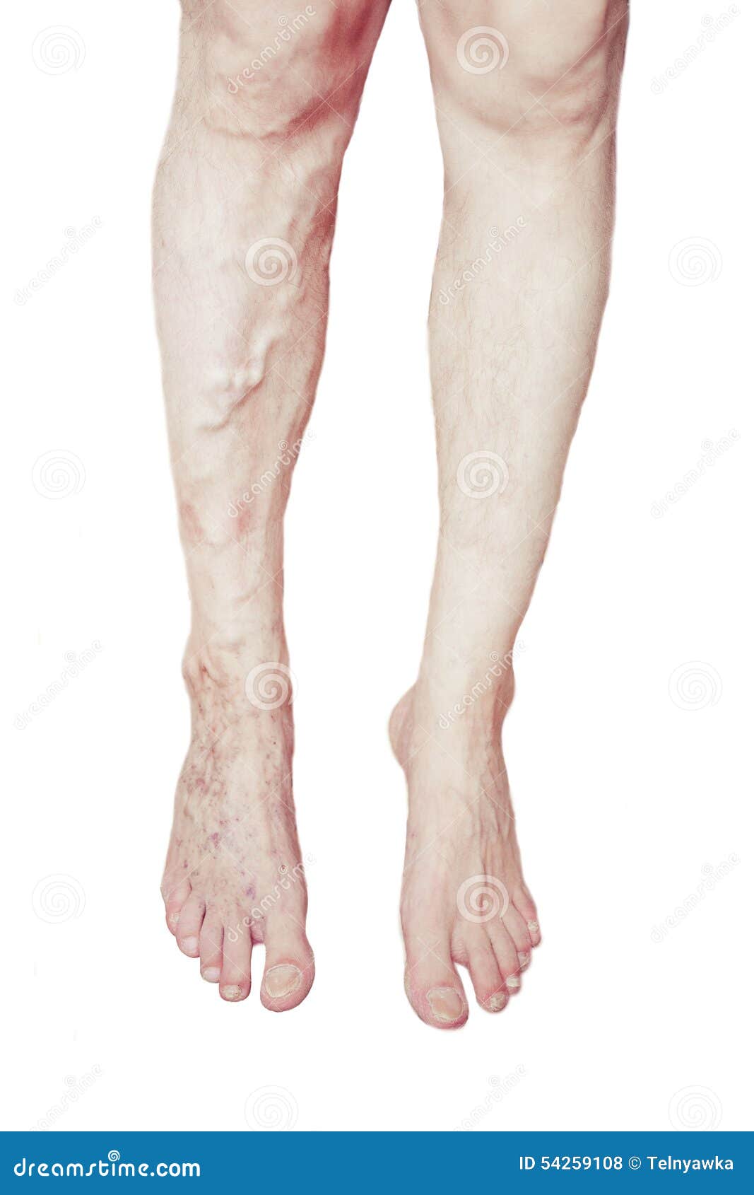 Varicose Veins on the leg stock photo. Image of distortion - 54259108