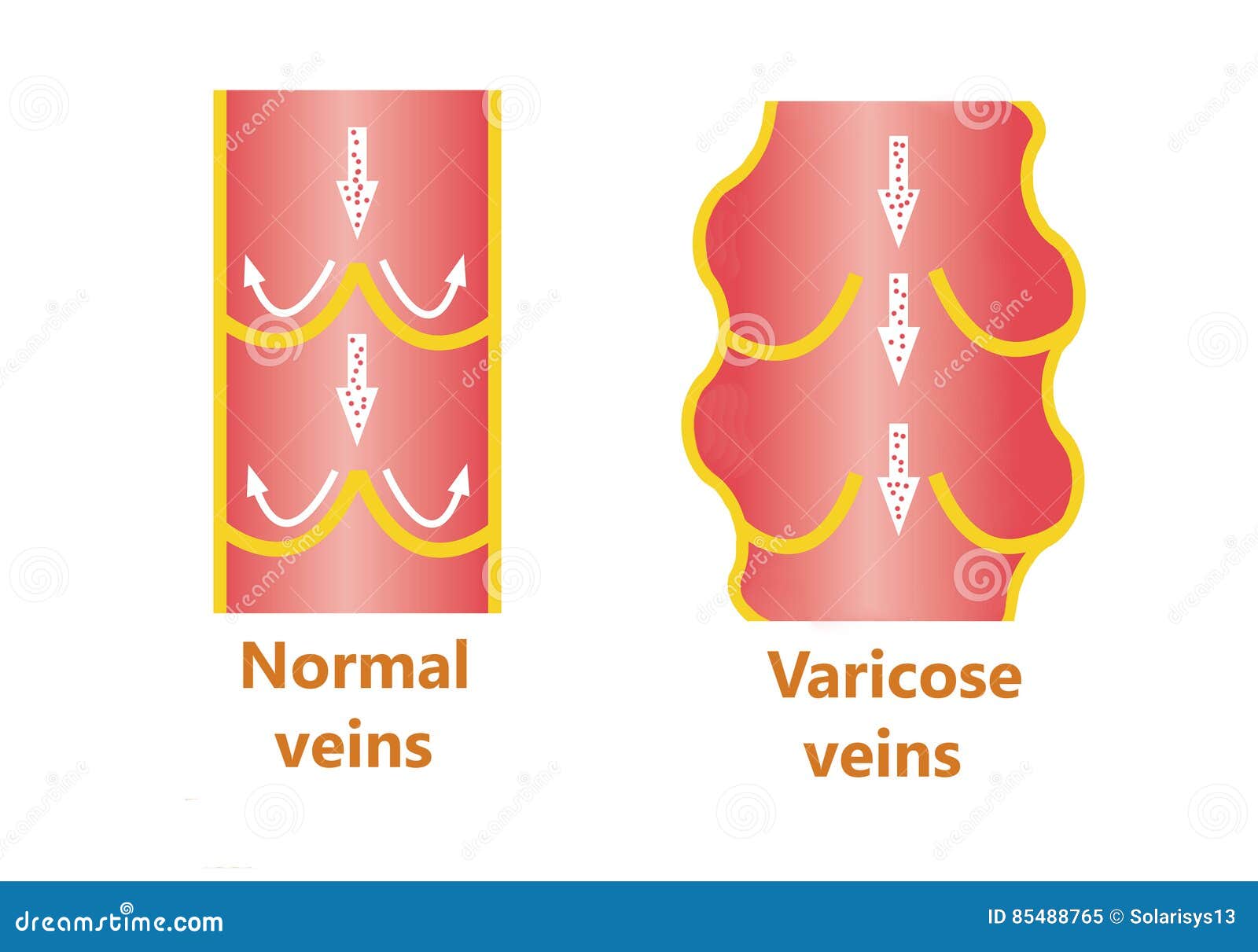 The Varicose Veins and Normal Veins Stock Illustration - Illustration ...