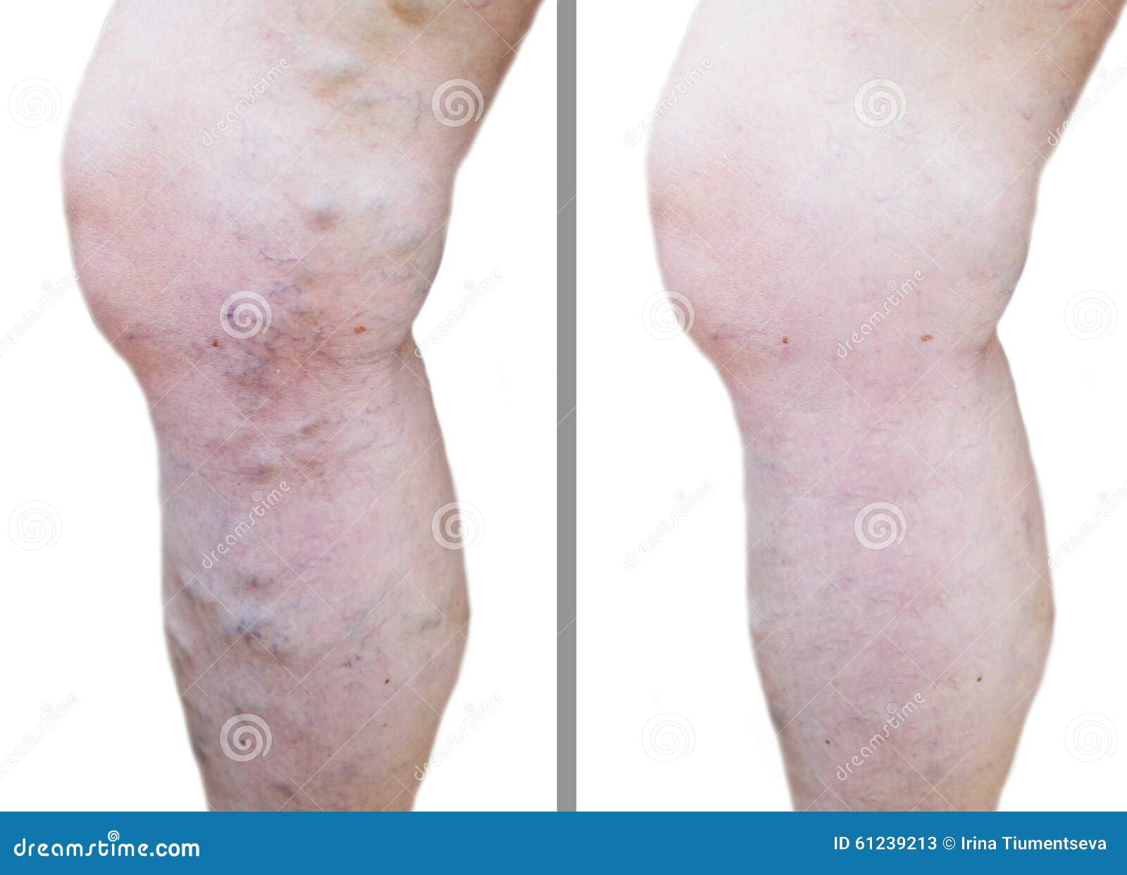 Varicose veins stock image. Image of science, disfigurement - 61239213