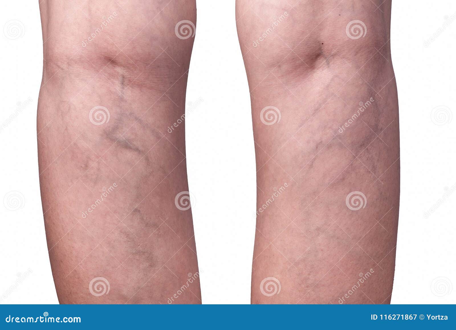 Varicose veins on white stock image. Image of senior - 116271867