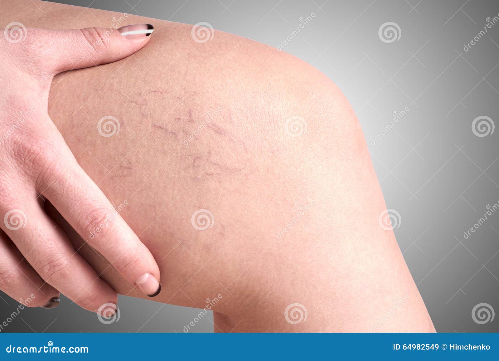 Varicose veins in women stock image. Image of young, veins - 64982549
