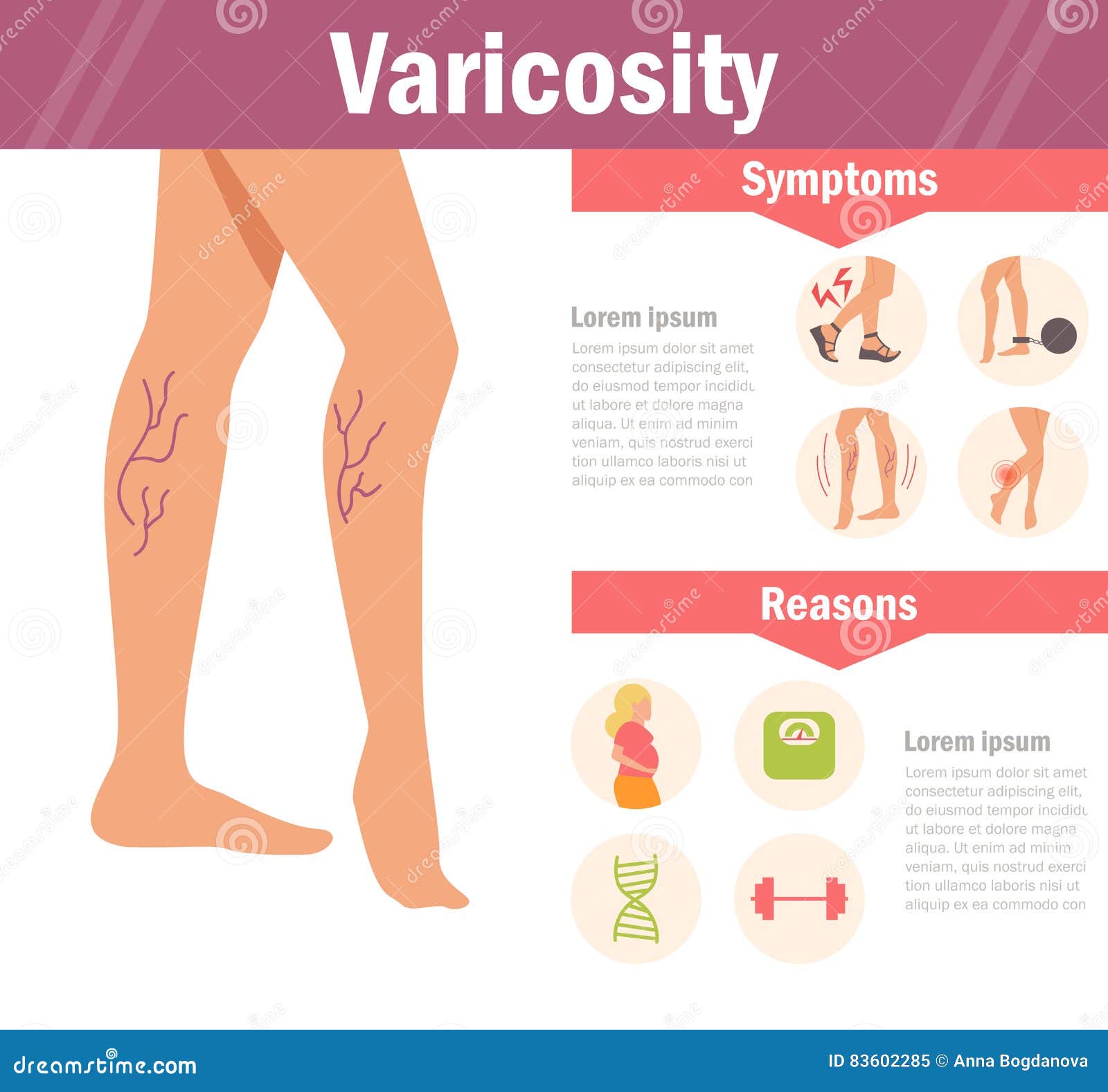 Varicosity Vecteur cartoon illustration de vecteur. Illustration du ...