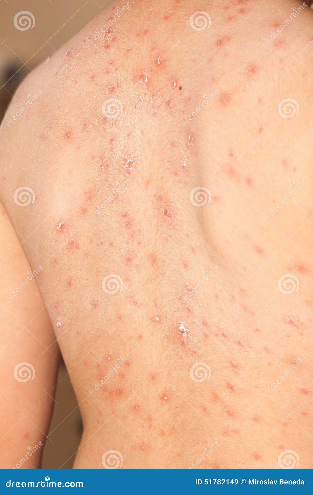 Variole Photo stock - Image: 51782149