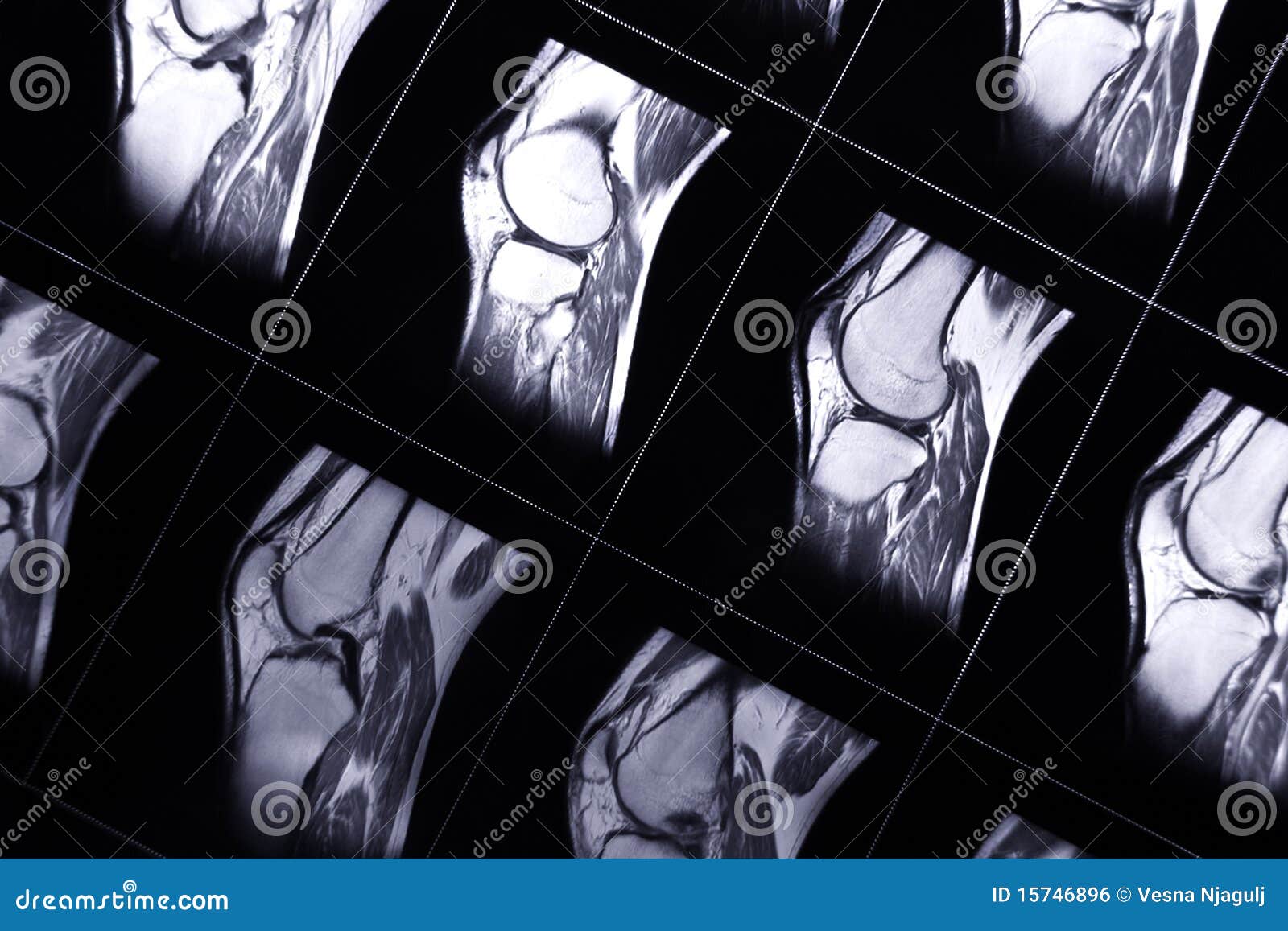 Varios Niveles De La Rodilla MRI Foto de archivo - Imagen de ...