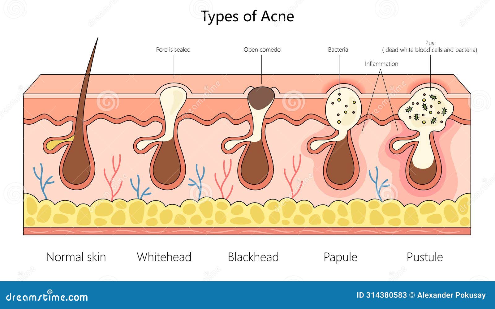 Different Acne Types Diagram Medical Science Stock Vector ...