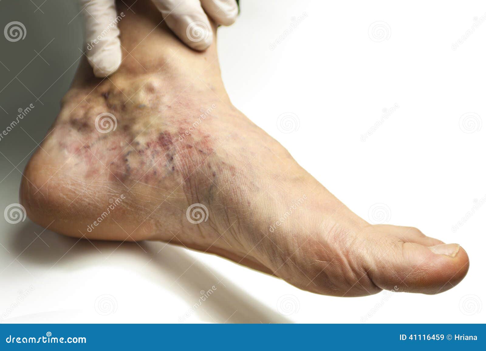 Variz imagen de archivo. Imagen de vascular, edema, lower - 41116459
