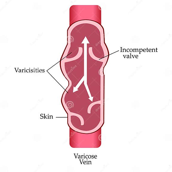 Variz del vector Variz stock de ilustración. Ilustración de ...