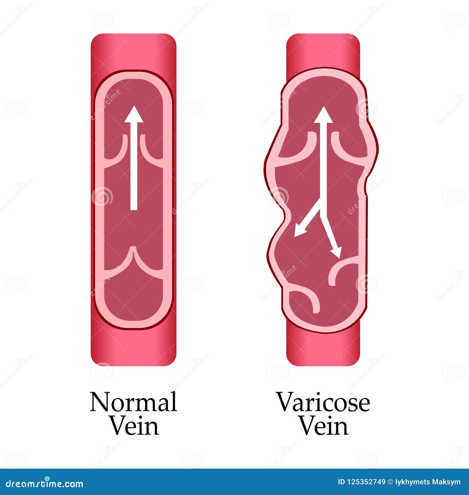 Variz Del Vector Y Vena Normal Variz Stock de ilustración - Ilustración ...