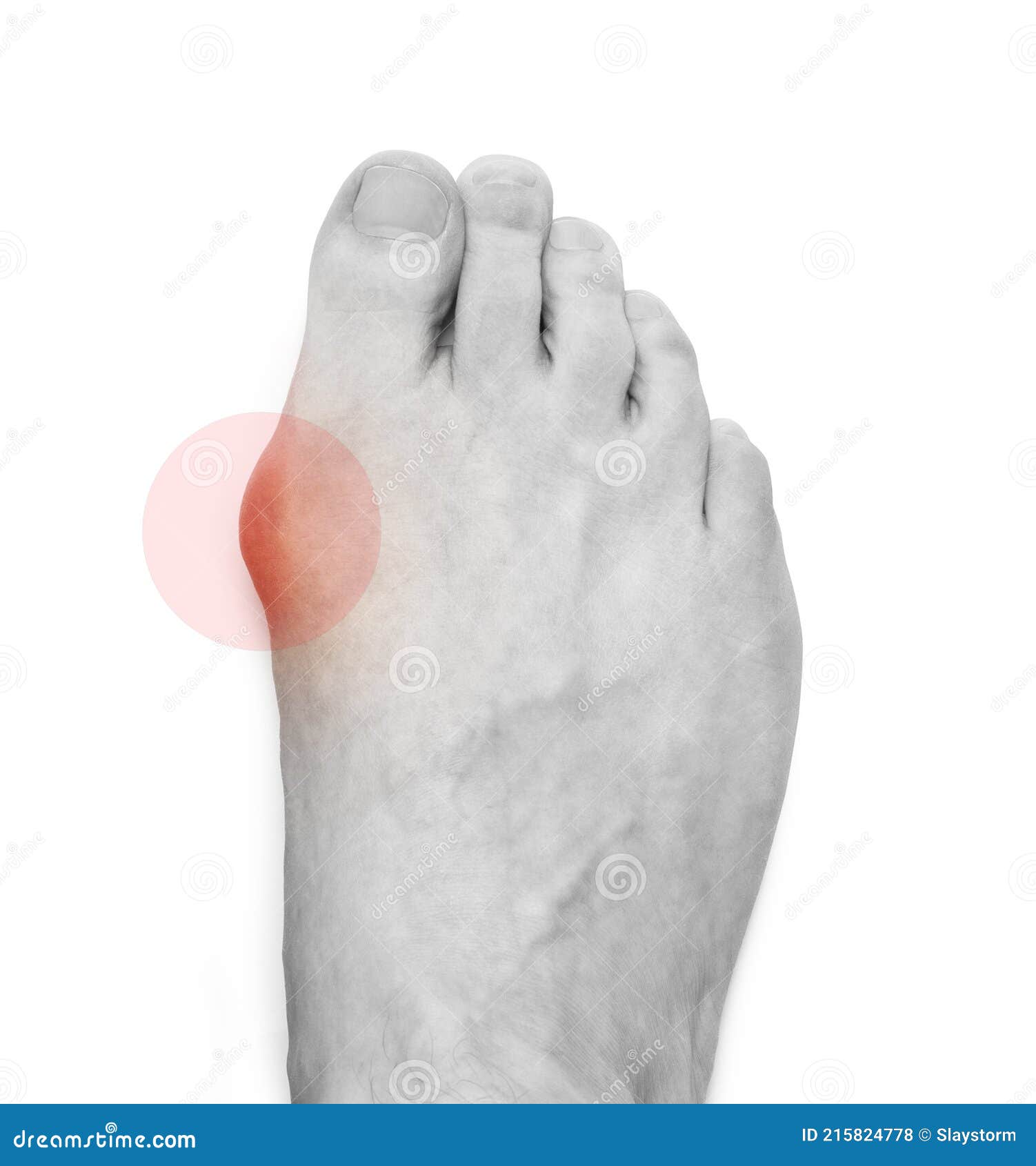 Varus Valgus And Hallux Valgus Or Bunion On Middle Aged Woman Foot ...