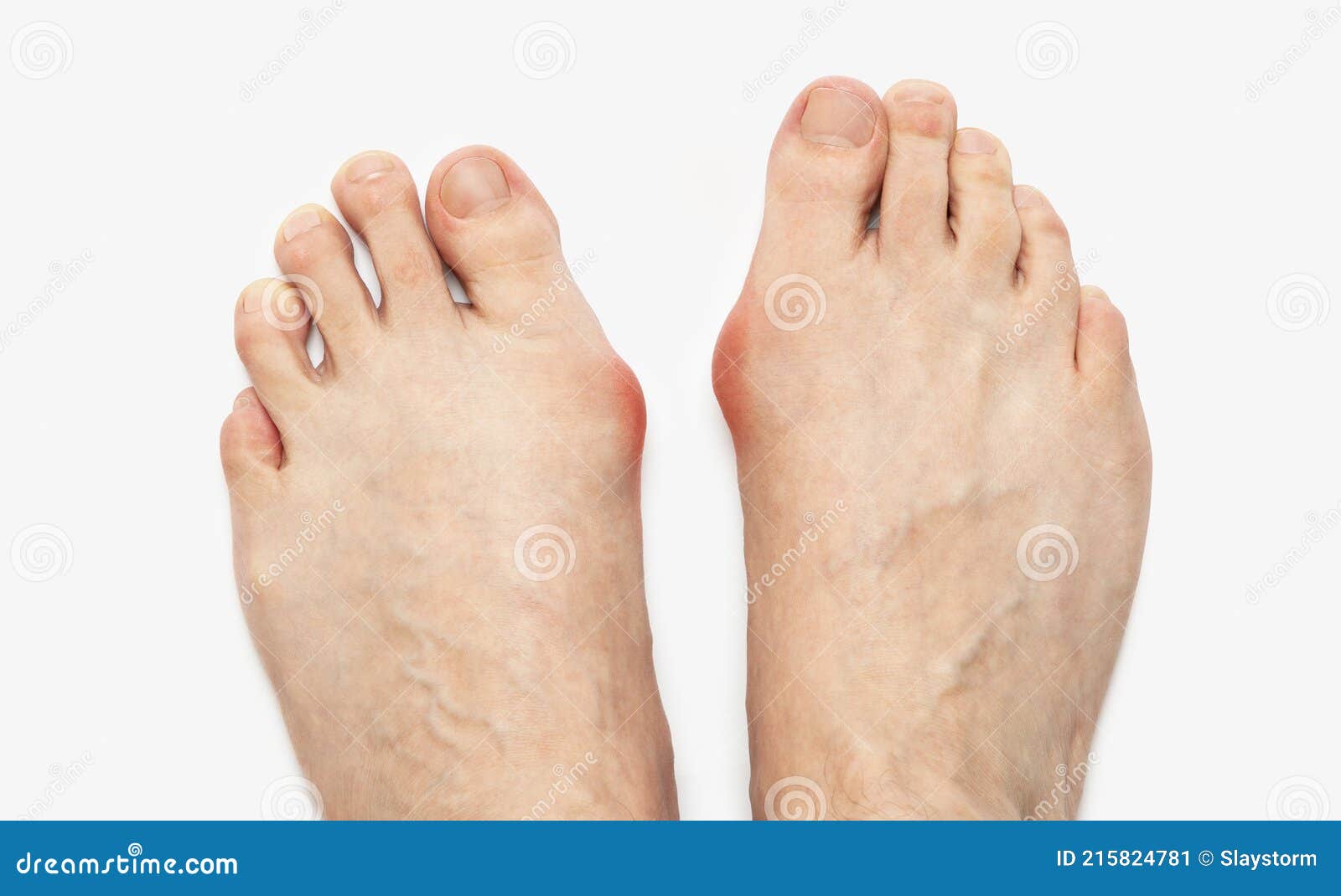 Varus Valgus And Hallux Valgus, Bunion On White Background. Empty Space ...