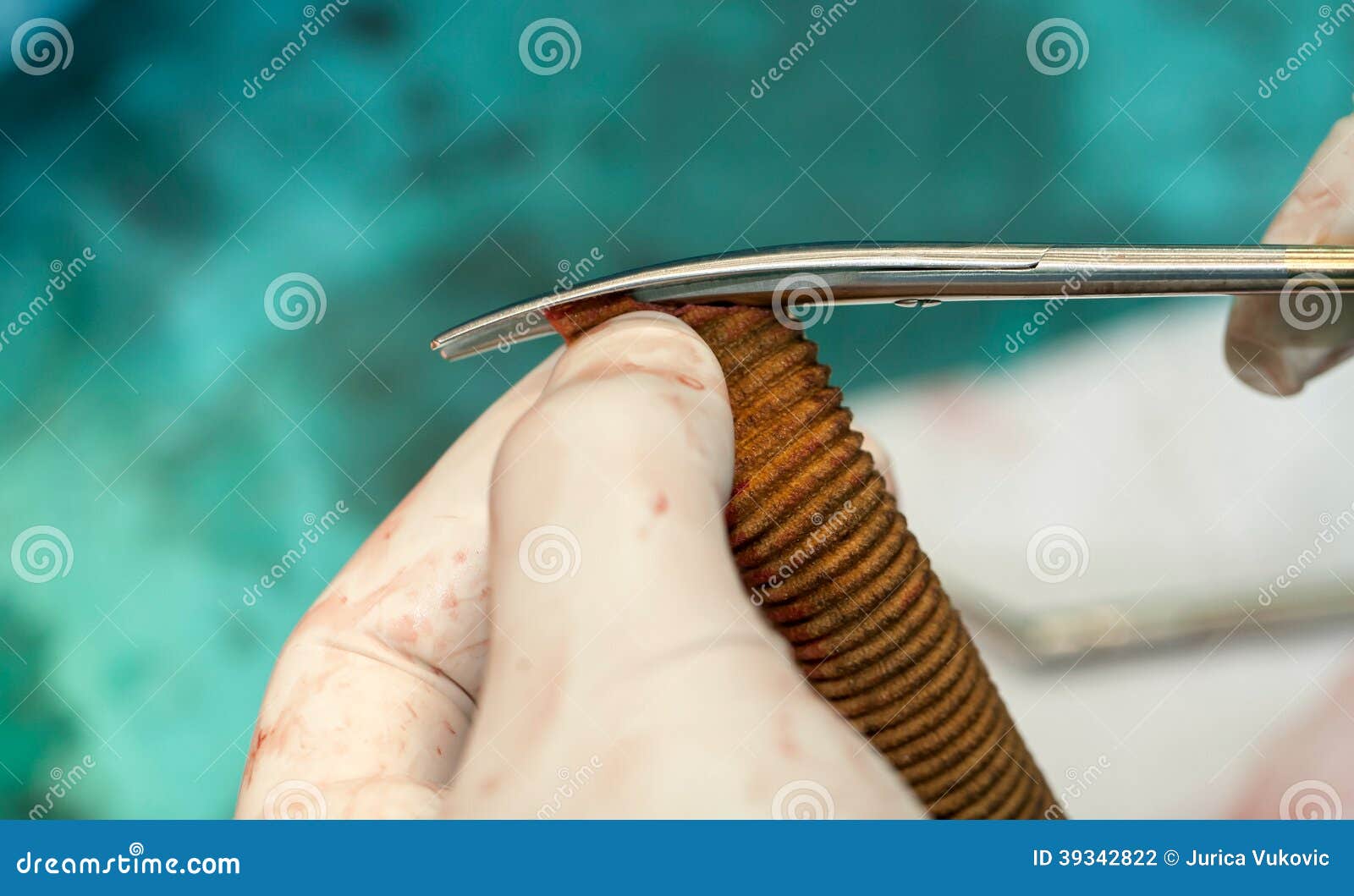 Vascular prosthesis stock photo. Image of sterile, precision - 39342822
