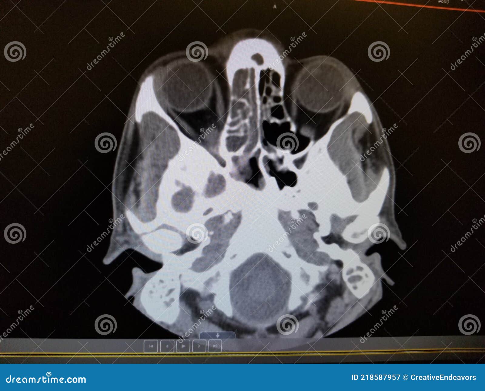 Vasculitis with Ethmoid Sinusitis - CT Scan of the Sinuses and Face ...