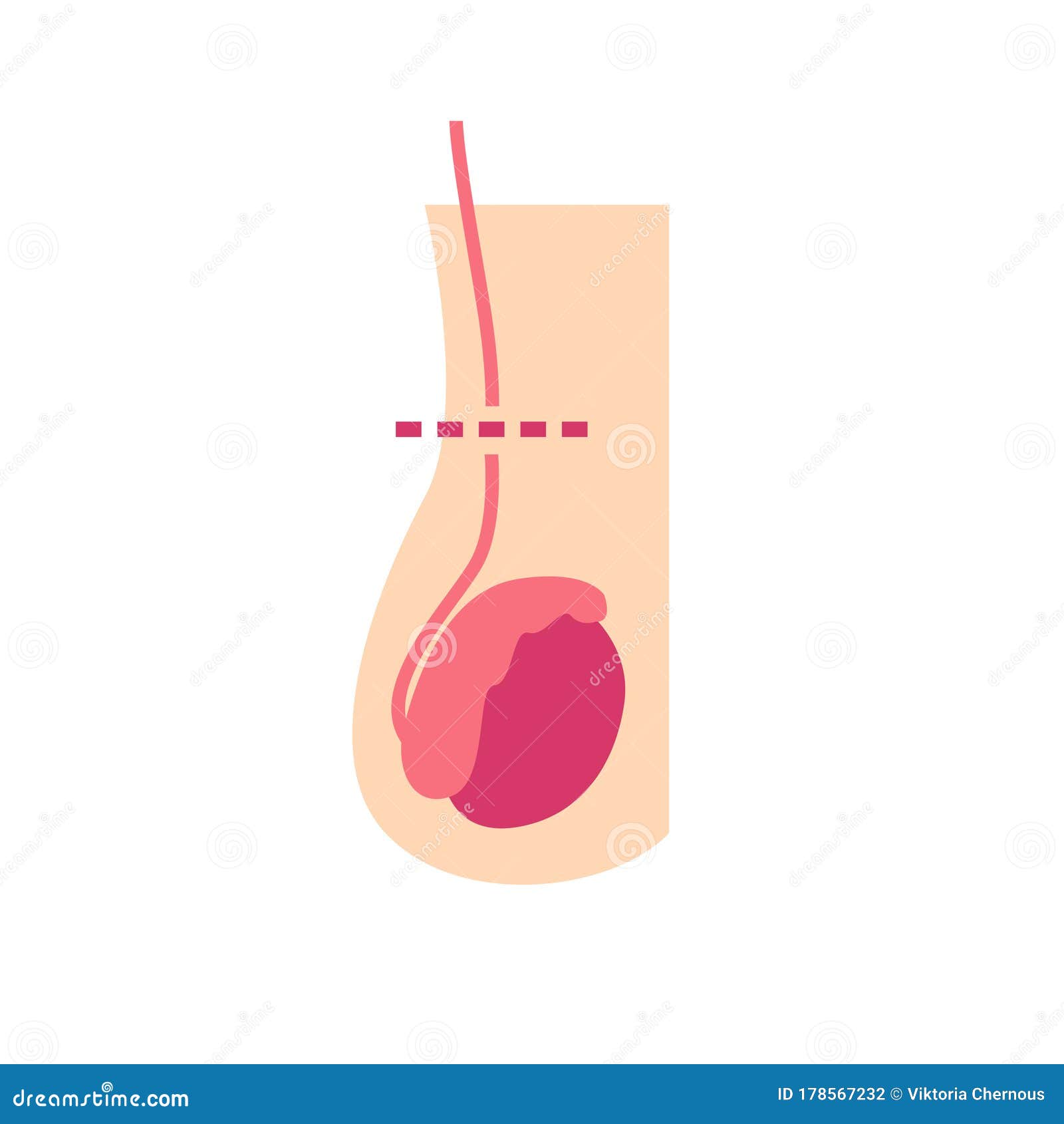 Vasectomy Flat Icon, Vector Illustration Stock Vector - Illustration of thin, contraception ...