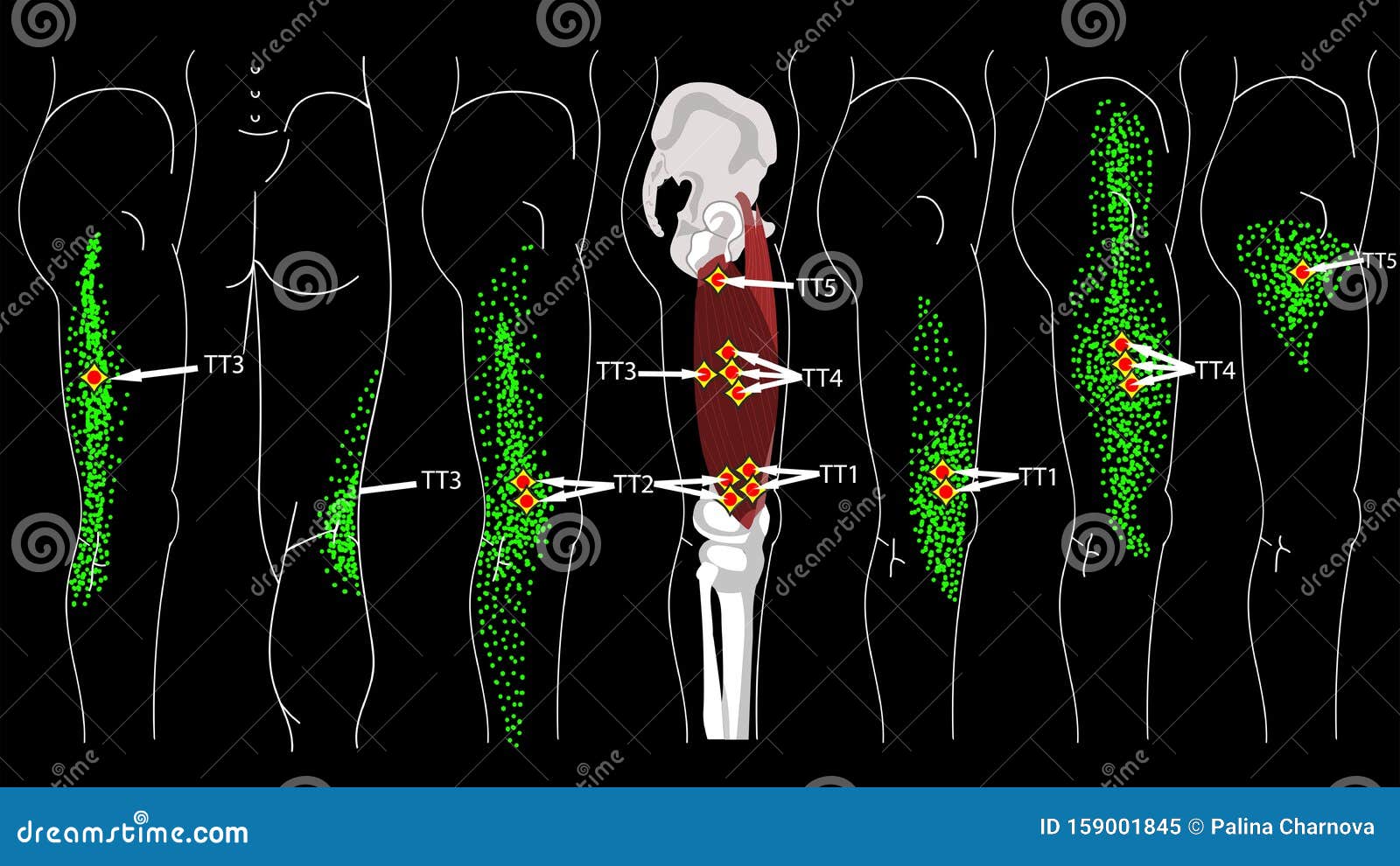 Vastus Lateralis Trigger Points. Leg Pain. Release Stock Vector ... Vastus Lateralis Trigger Points. Leg Pain. Release Stock Vector ...