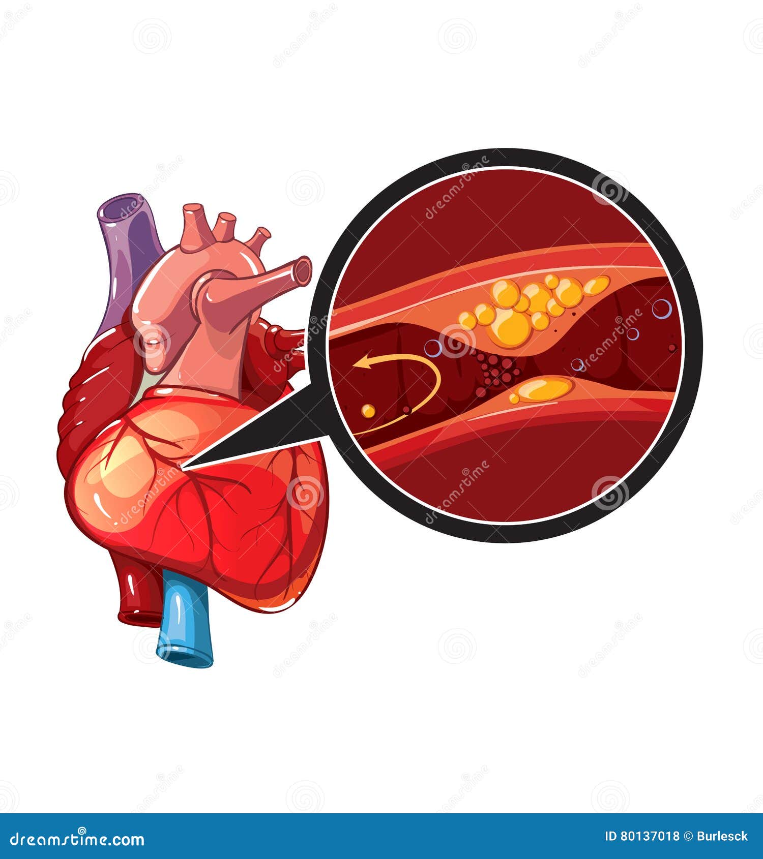 Vecteur D'infarctus Du Myocarde Illustration de Vecteur - Illustration ...