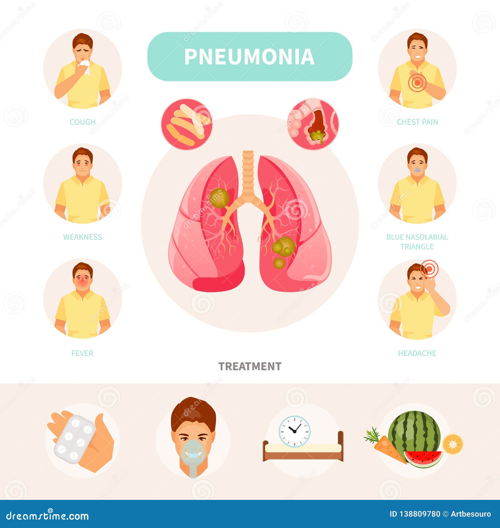 Vecteur Infographic De Pneumonie Illustration de Vecteur - Illustration ...