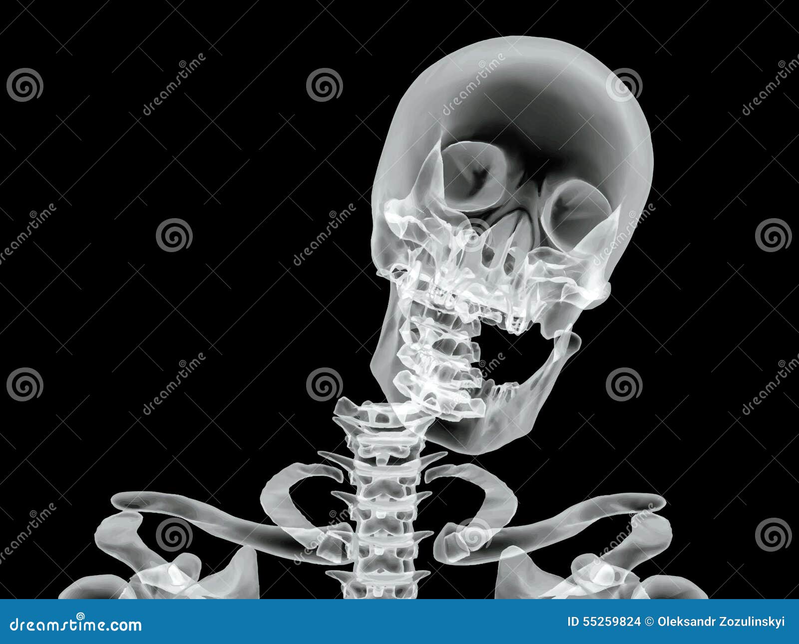 Vector Broken Bone X-ray Image Stock Vector - Illustration of anatomy ...