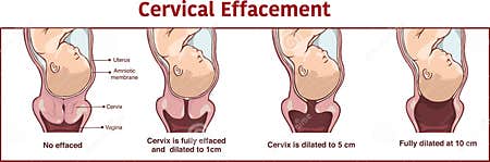 Vector - Cervical Effacement and Dilatation during Labor Stock Vector ...