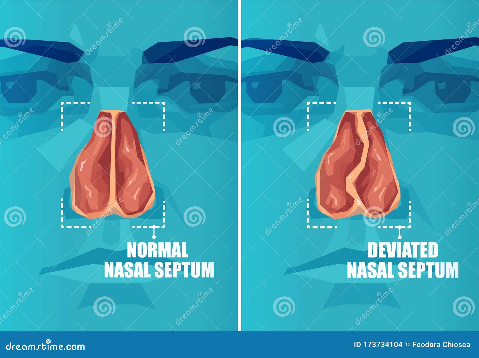 Vector Cross Section of Face with Deviated and Normal Nasal Septum ...