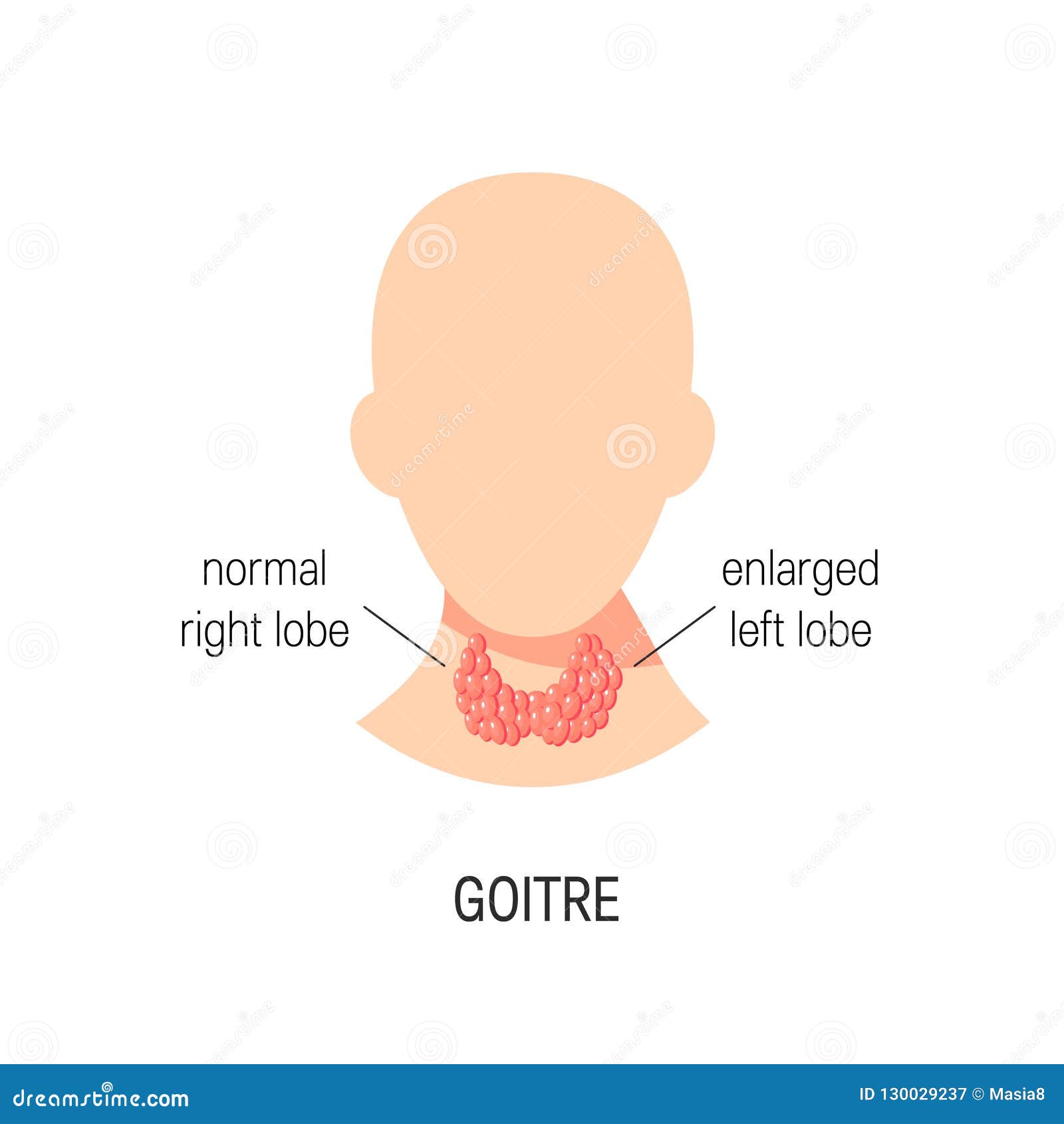 Vector De La Enfermedad Del Bocio Ilustración del Vector - Ilustración ...