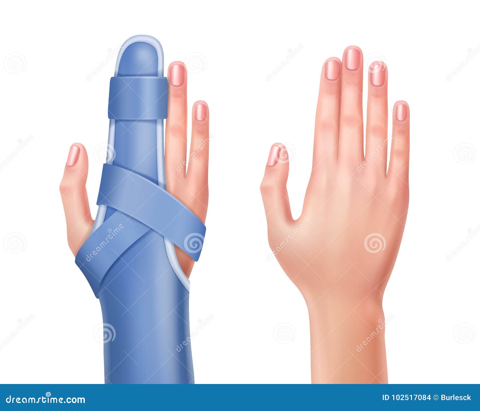 Splint Cartoons, Illustrations & Vector Stock Images - 1516 Pictures to ...
