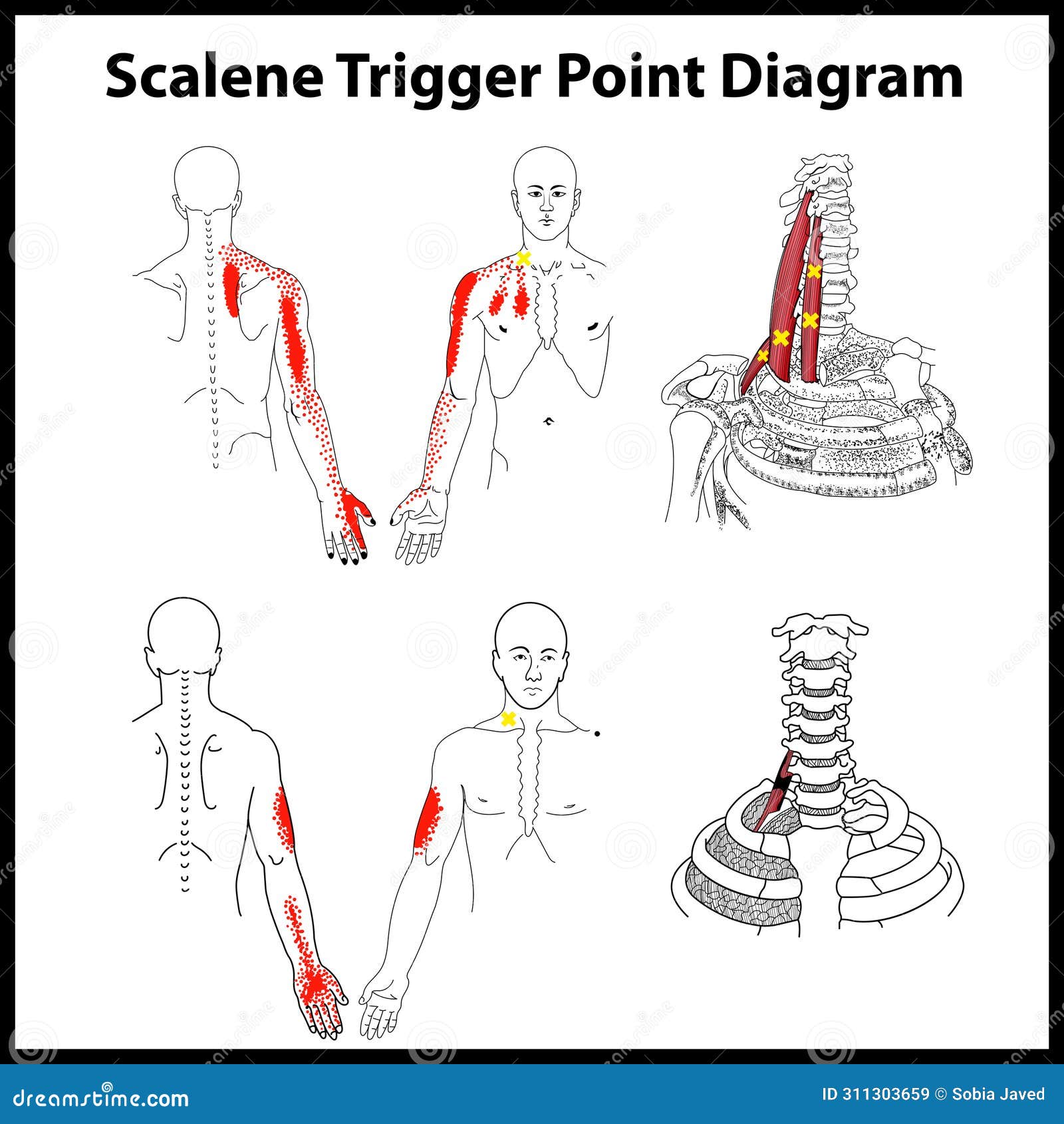 Scalene Trigger Point Vector Diagram Stock Vector - Illustration of ...