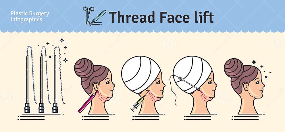 Vector Illustrated Set with Face Lifting Surgery by Threads Stock ...