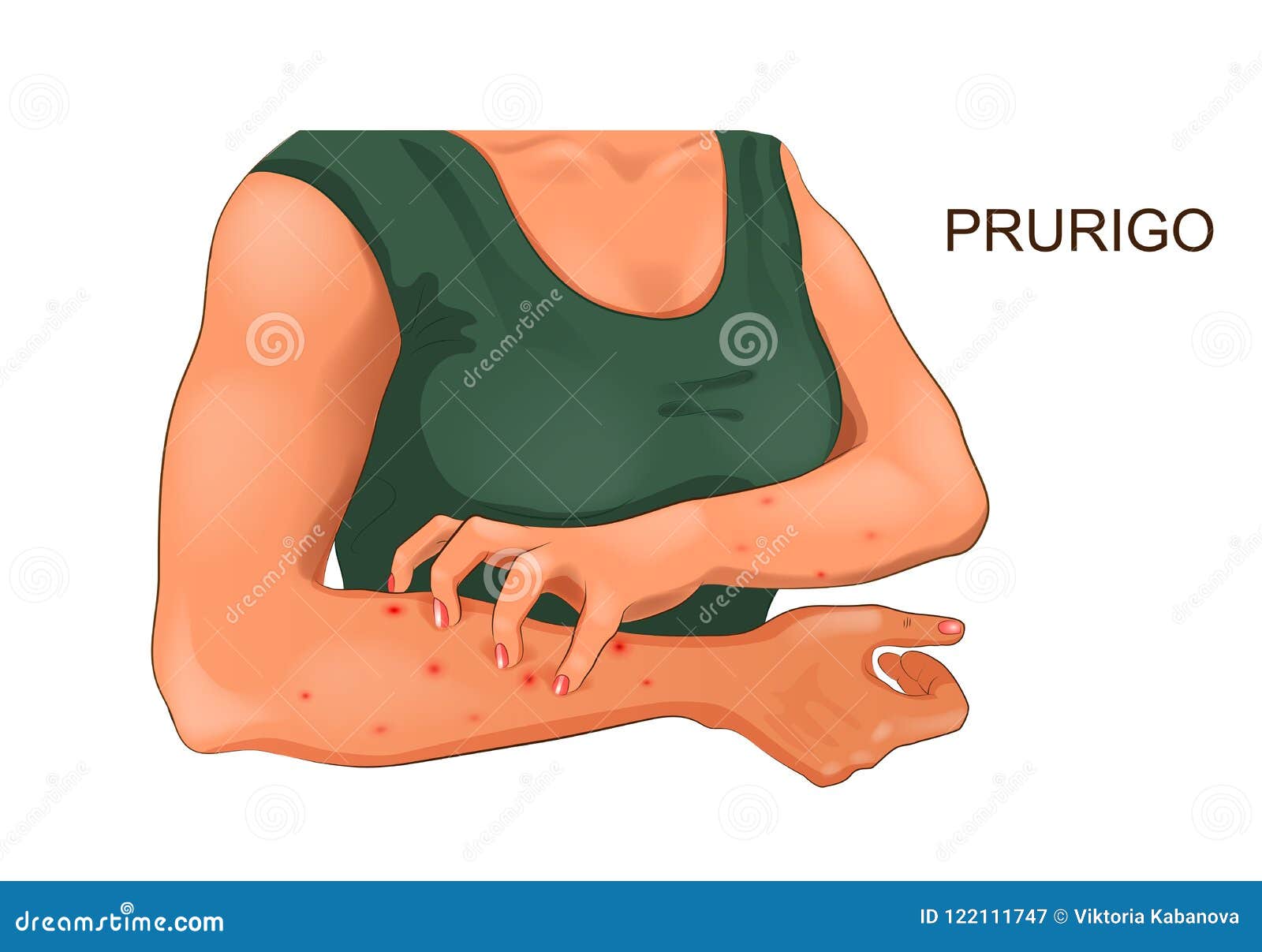 Allergic Itching of the Skin Stock Vector - Illustration of medical ...