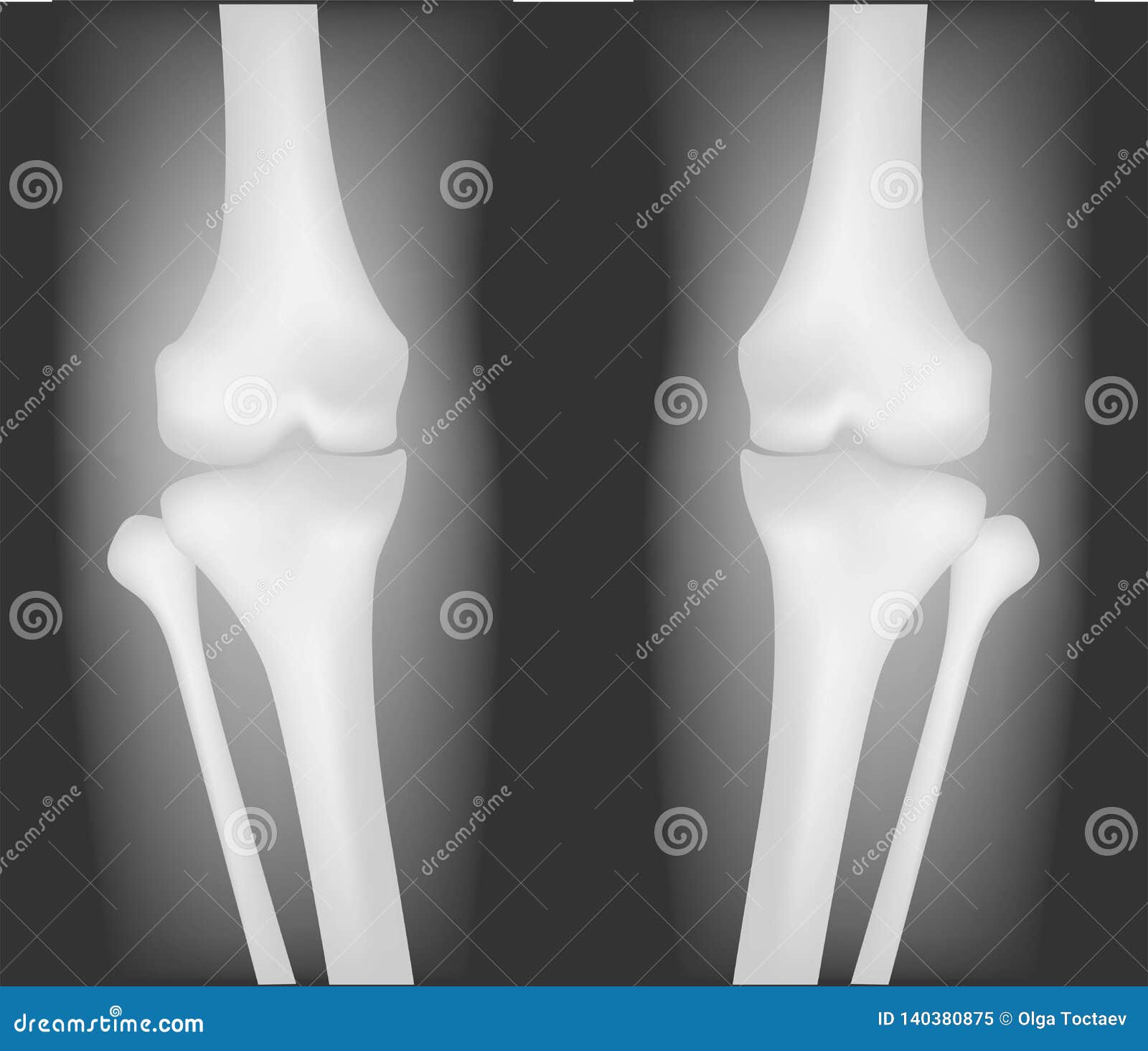 Realistic Knee Joints. Osteoarthritis Treatment, Anti Inflammatory ...