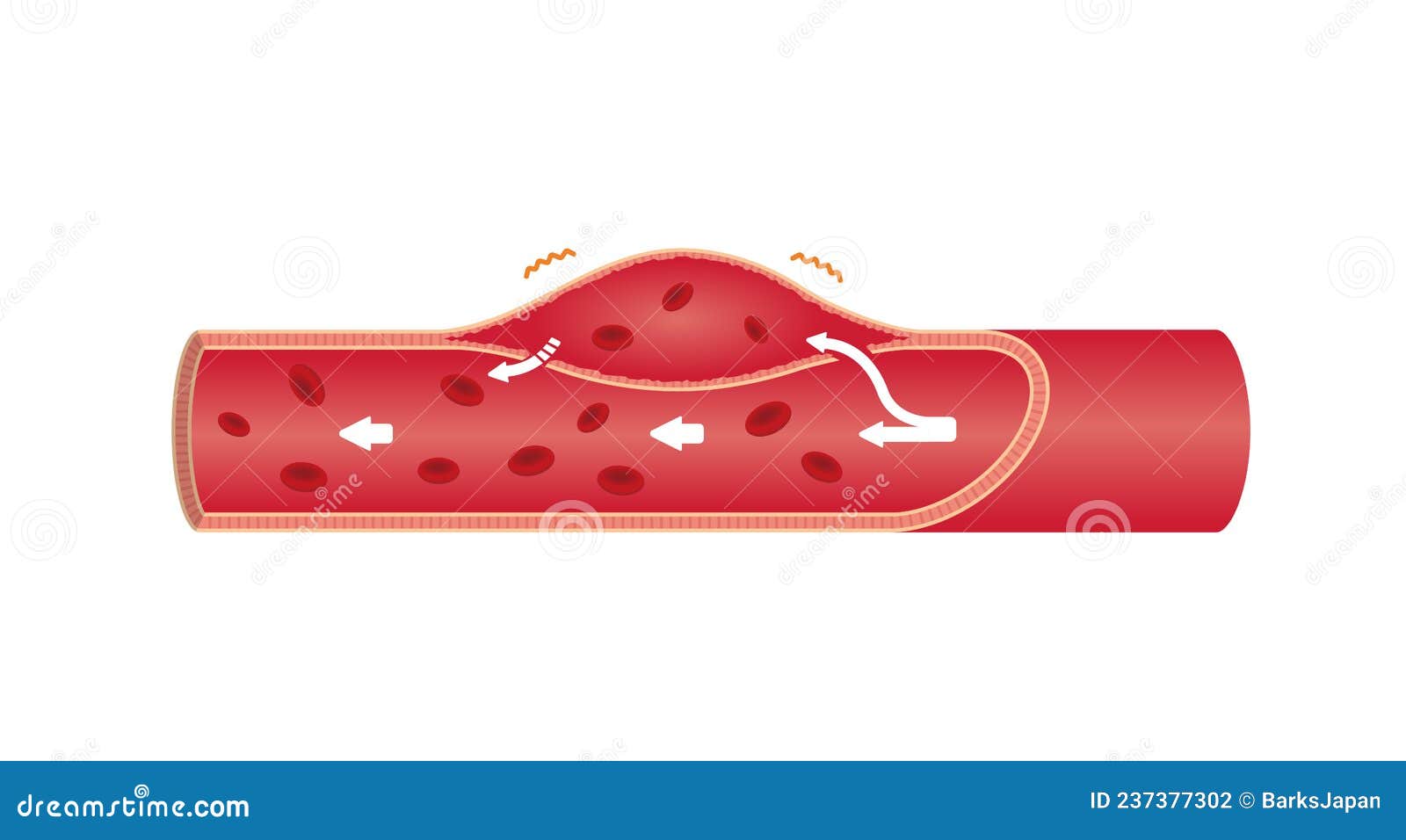 Aortic Dissection. Longitudinal And Cross-section Of Blood Vessel ...