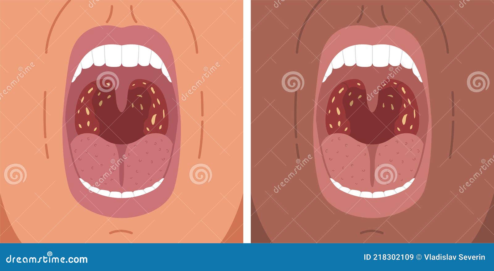 Tonsil Stones Vector Illustration. Labeled Medical Tonsillolith ...